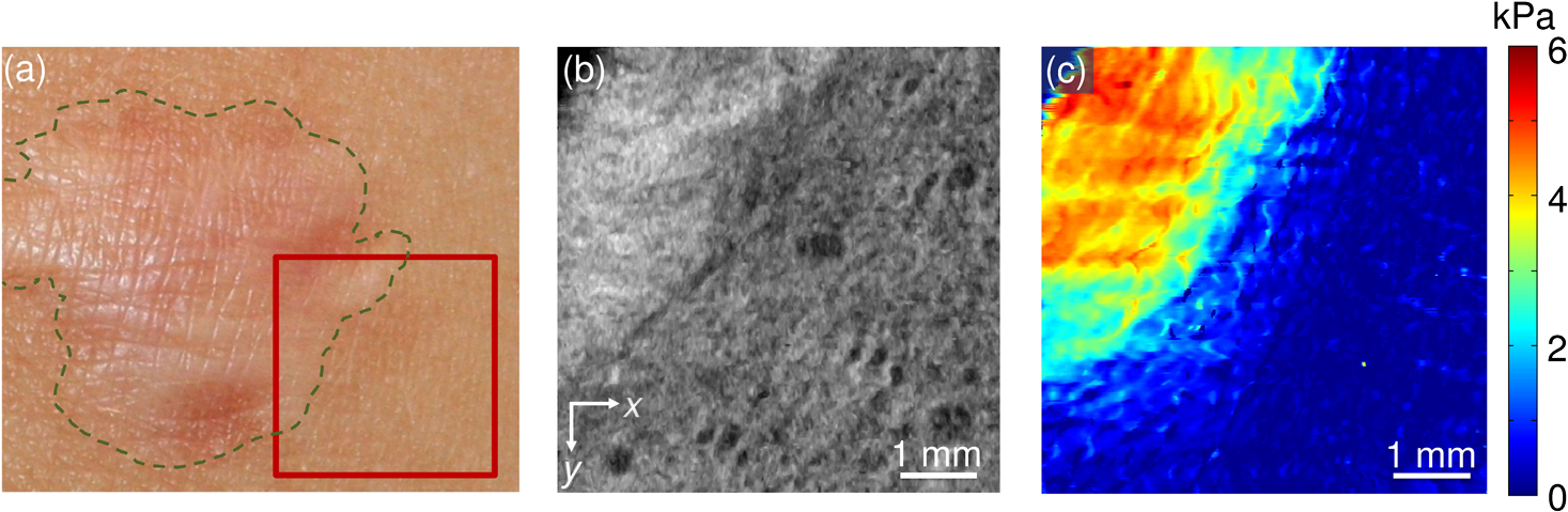 Optical palpation in vivo: imaging human skin lesions using mechanical ...